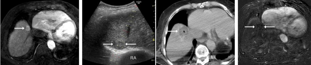Safety of MWA Near the Heart – BraceGroup – UW–Madison